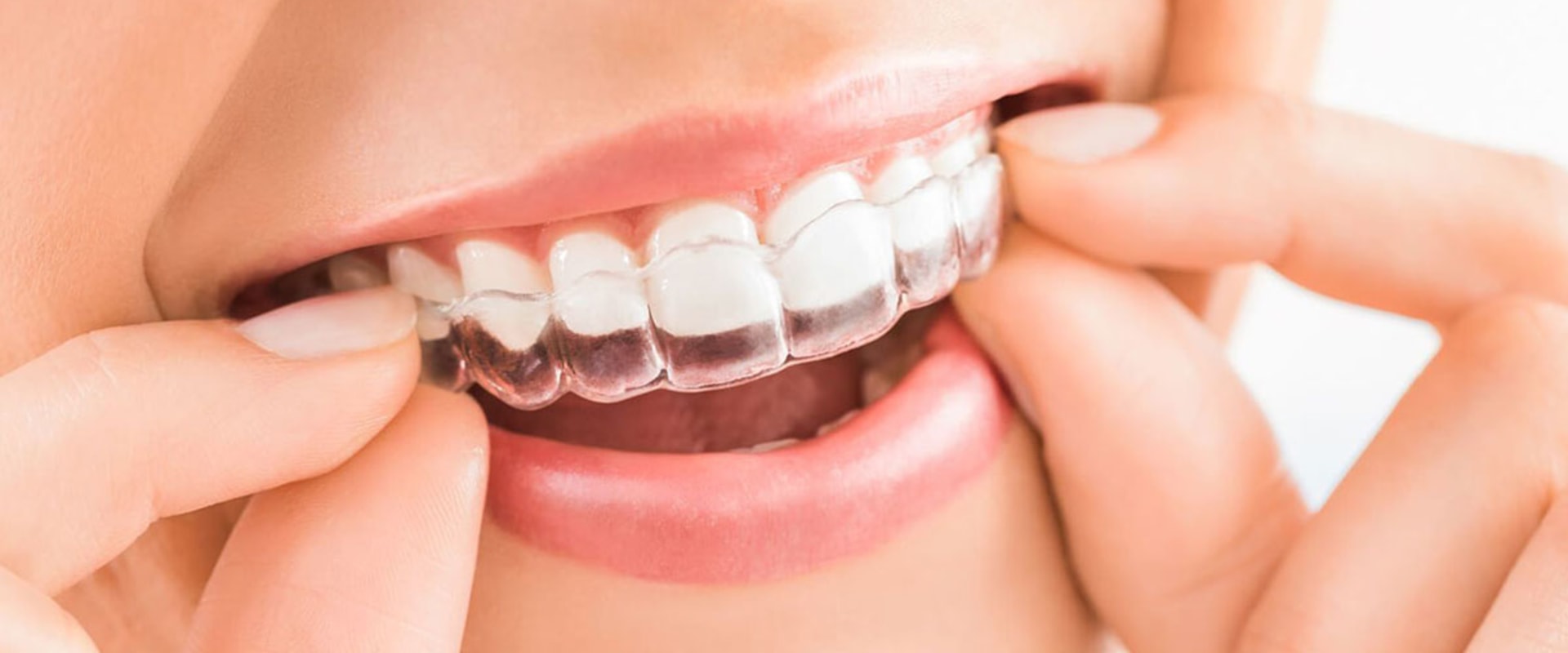 Maximizing Invisalign Results With Strategic Tooth Extraction In Georgetown