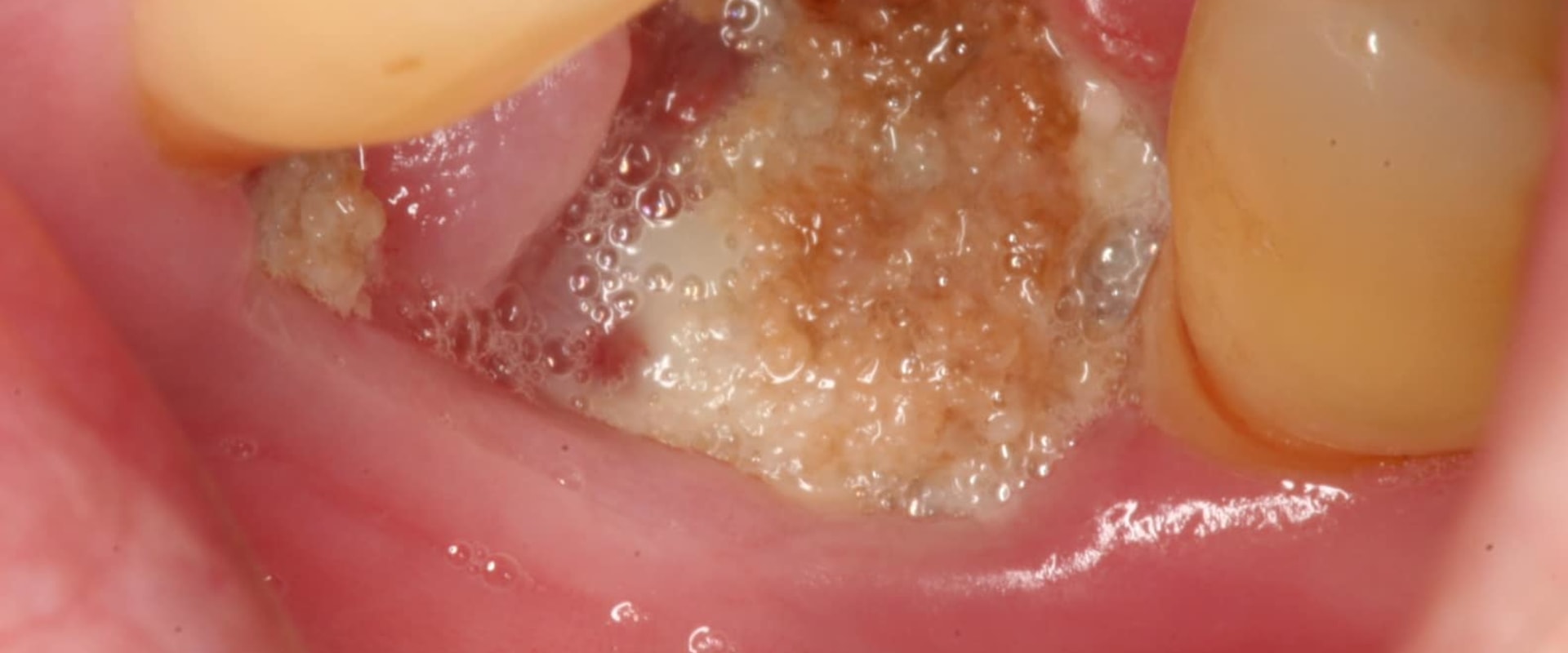 Signs of Infection After Tooth Extraction: What to Look Out For