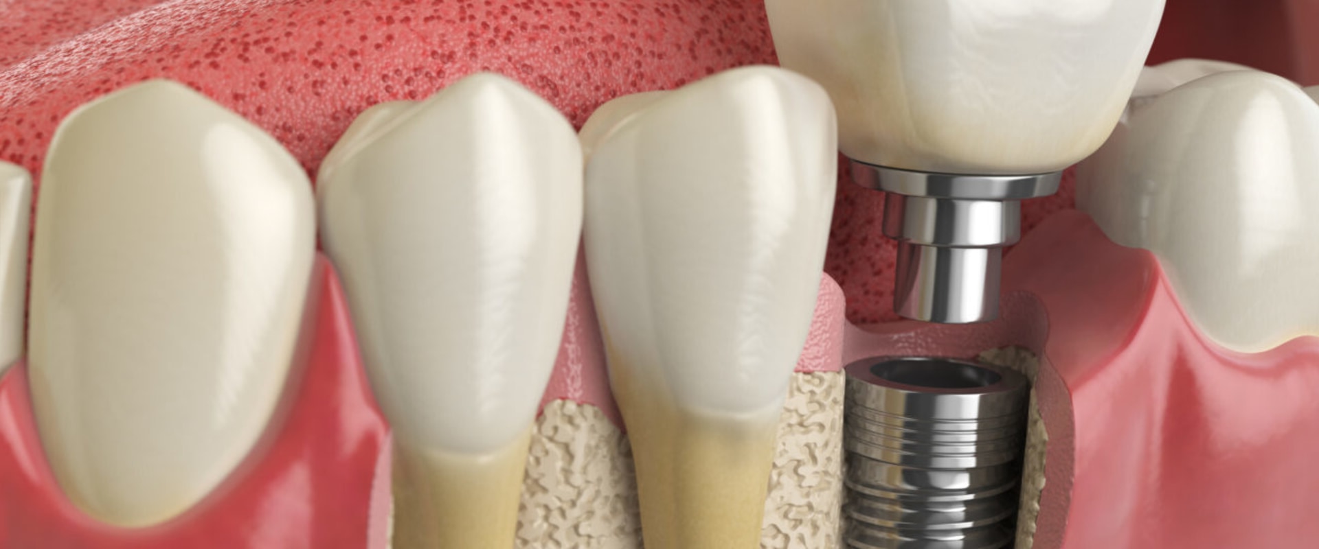 How To Prepare For Dental Implant Surgery After Tooth Extraction In ...