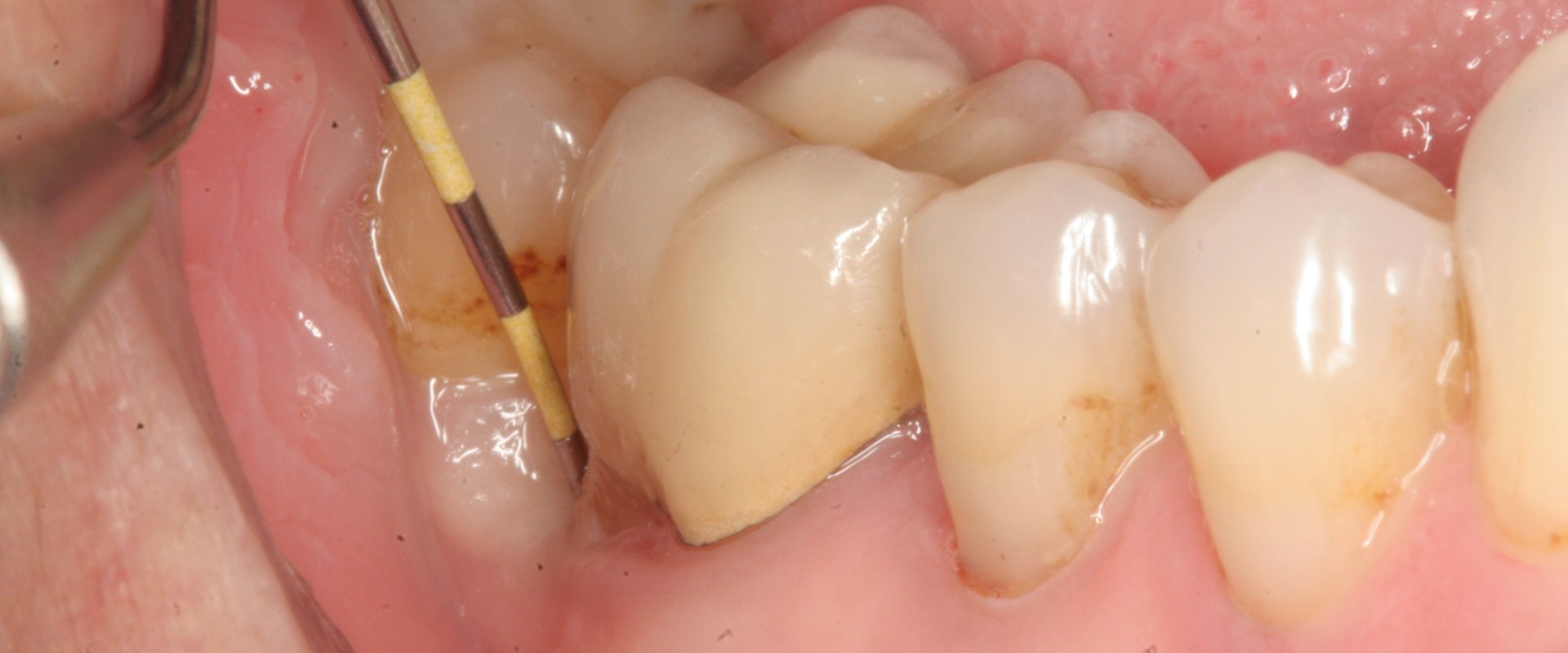 Will an Abscess Go Away After Tooth Extraction?